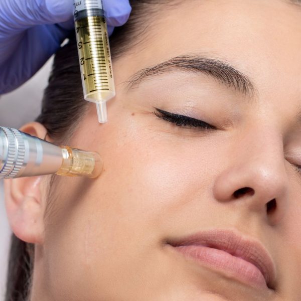 Aerolase Acne Treatment, Breakout Prevention and Scar Revision - Bella ...